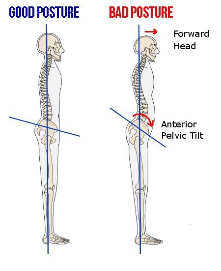 Anterior Pelvic Tilt "Cause" Lower Back Pain | Evidence-based Chiropractor