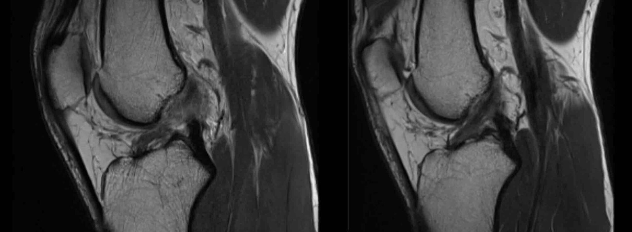 Understanding ACL Tears: Key Facts and Recovery Insights